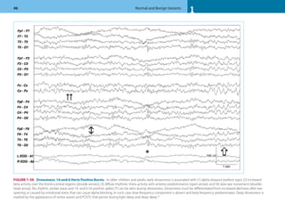 Atlas of Pediatric EEG.pdf