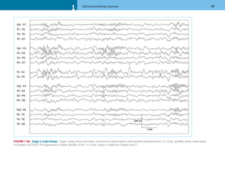 Atlas of Pediatric EEG.pdf