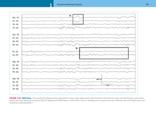 Atlas of Pediatric EEG.pdf