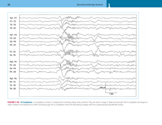 Atlas of Pediatric EEG.pdf