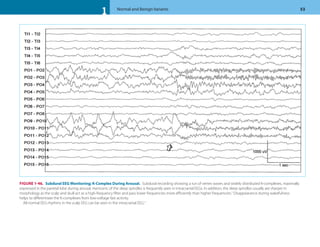 Atlas of Pediatric EEG.pdf