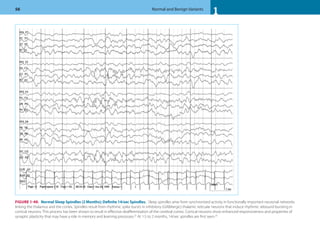Atlas of Pediatric EEG.pdf