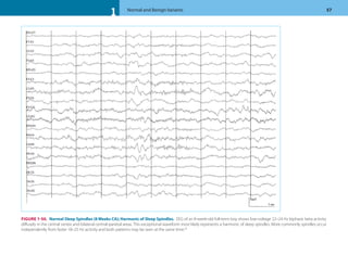 Atlas of Pediatric EEG.pdf