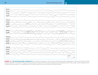 Atlas of Pediatric EEG.pdf
