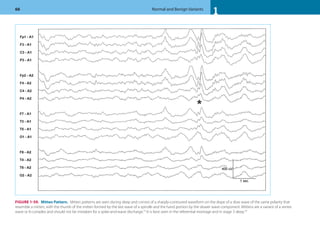Atlas of Pediatric EEG.pdf