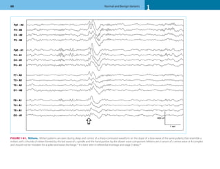 Atlas of Pediatric EEG.pdf