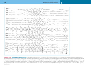 Atlas of Pediatric EEG.pdf
