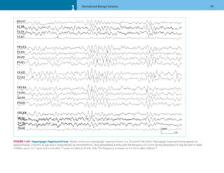 Atlas of Pediatric EEG.pdf