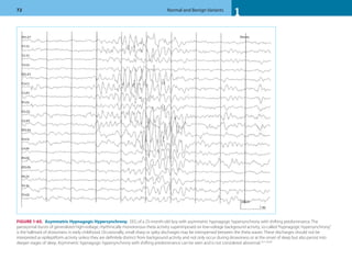 Atlas of Pediatric EEG.pdf