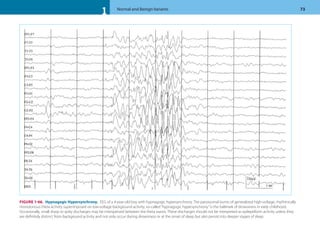 Atlas of Pediatric EEG.pdf