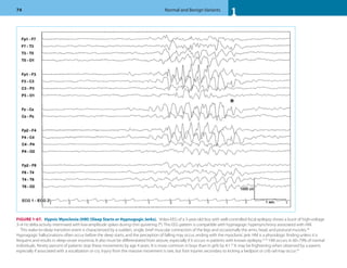 Atlas of Pediatric EEG.pdf
