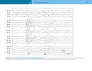 Atlas of Pediatric EEG.pdf