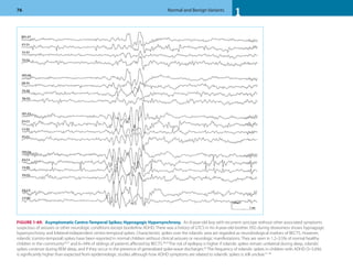 Atlas of Pediatric EEG.pdf