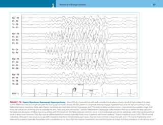 Atlas of Pediatric EEG.pdf