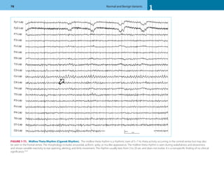 Atlas of Pediatric EEG.pdf