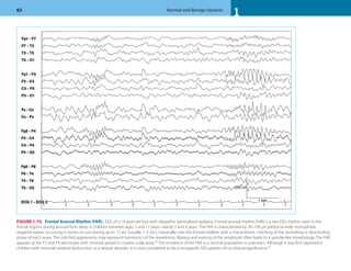 Atlas of Pediatric EEG.pdf