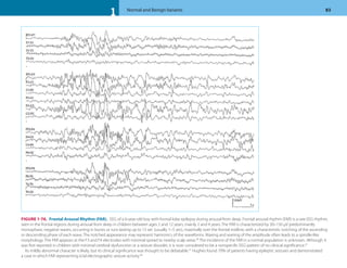 Atlas of Pediatric EEG.pdf