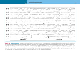 Atlas of Pediatric EEG.pdf