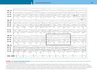 Atlas of Pediatric EEG.pdf