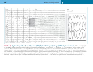 Atlas of Pediatric EEG.pdf