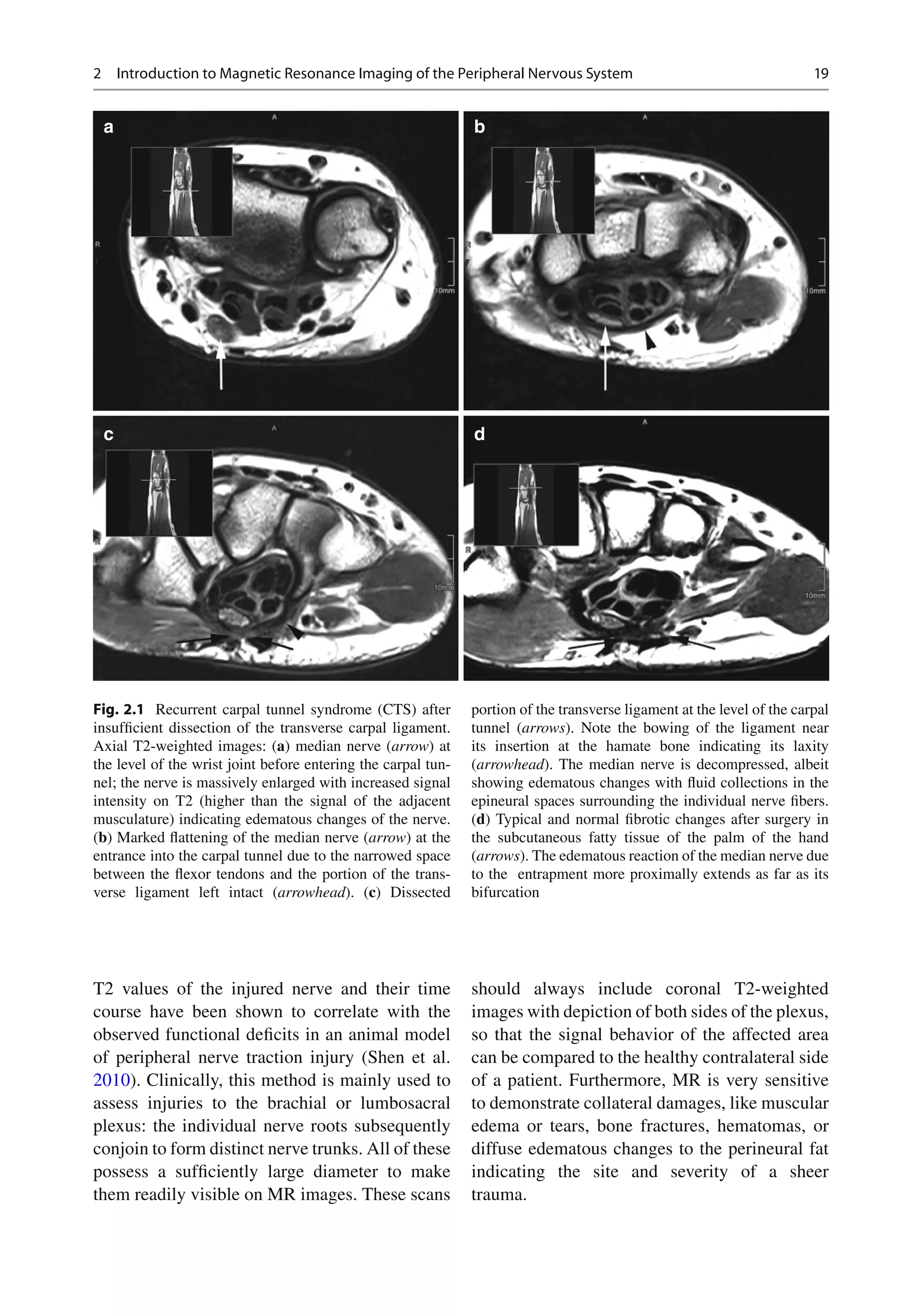 Atlas of peripheral nerve ultrasound | PDF