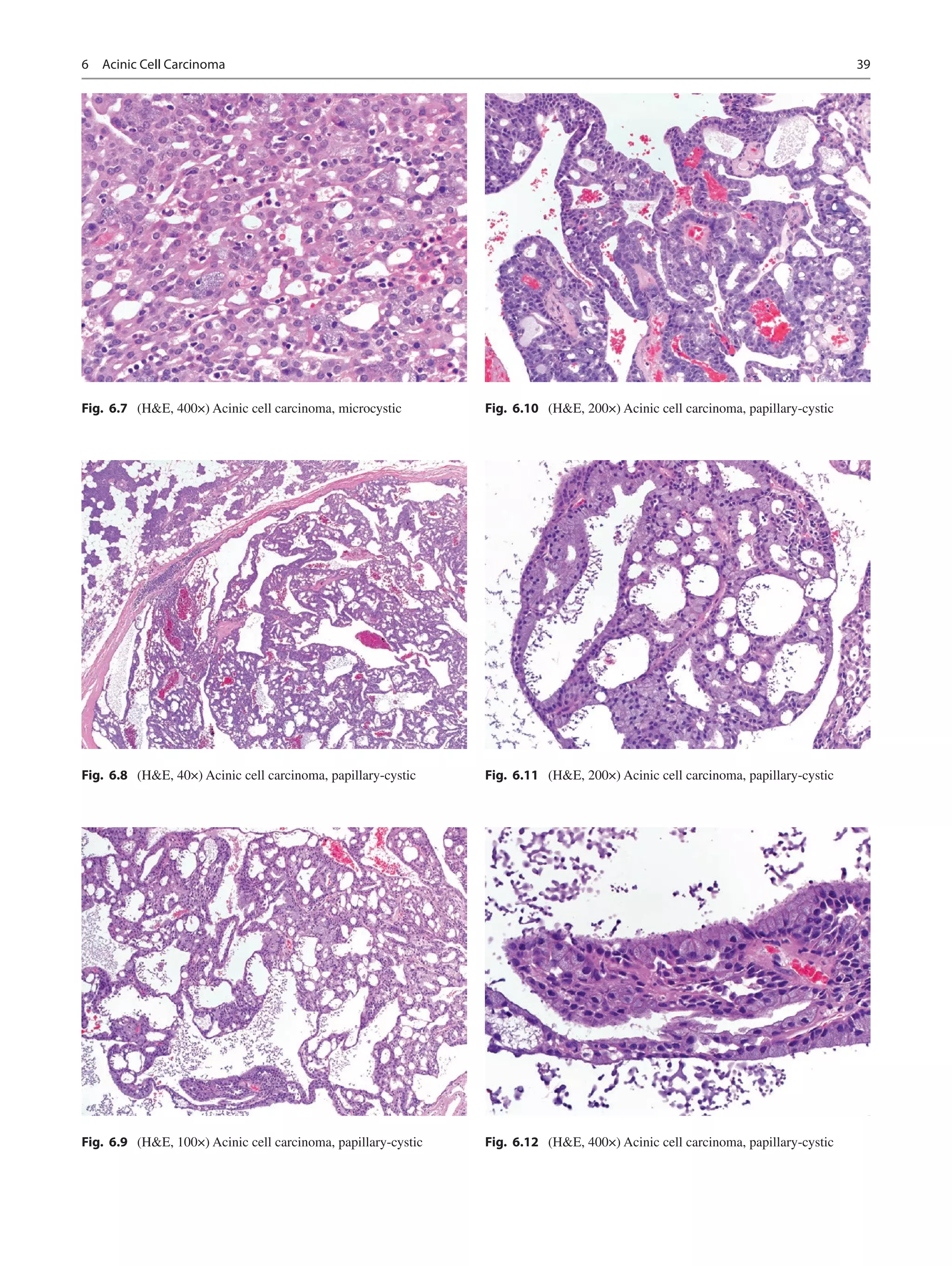 Atlas of salivary gland pathology | PDF