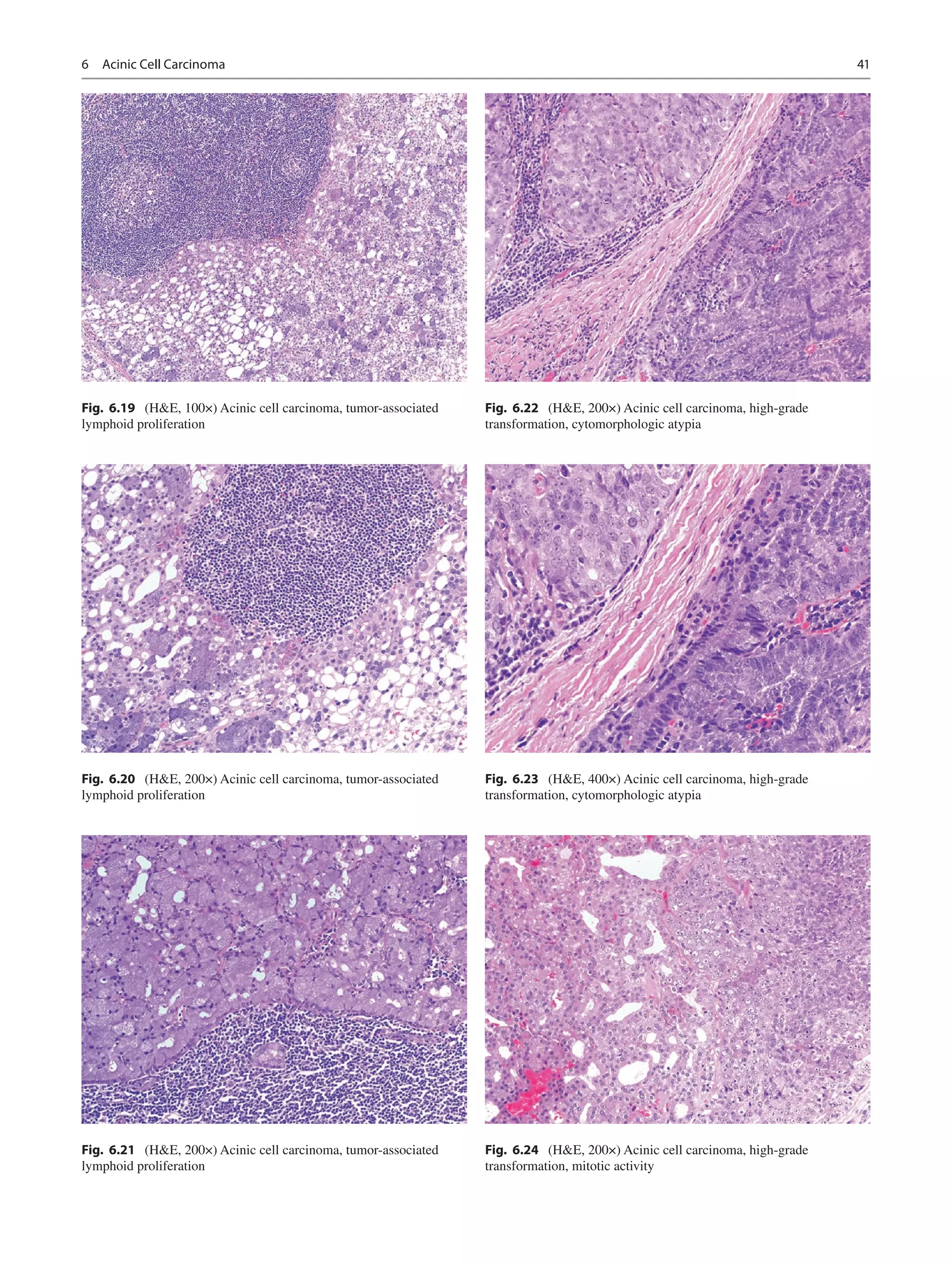 Atlas of salivary gland pathology | PDF