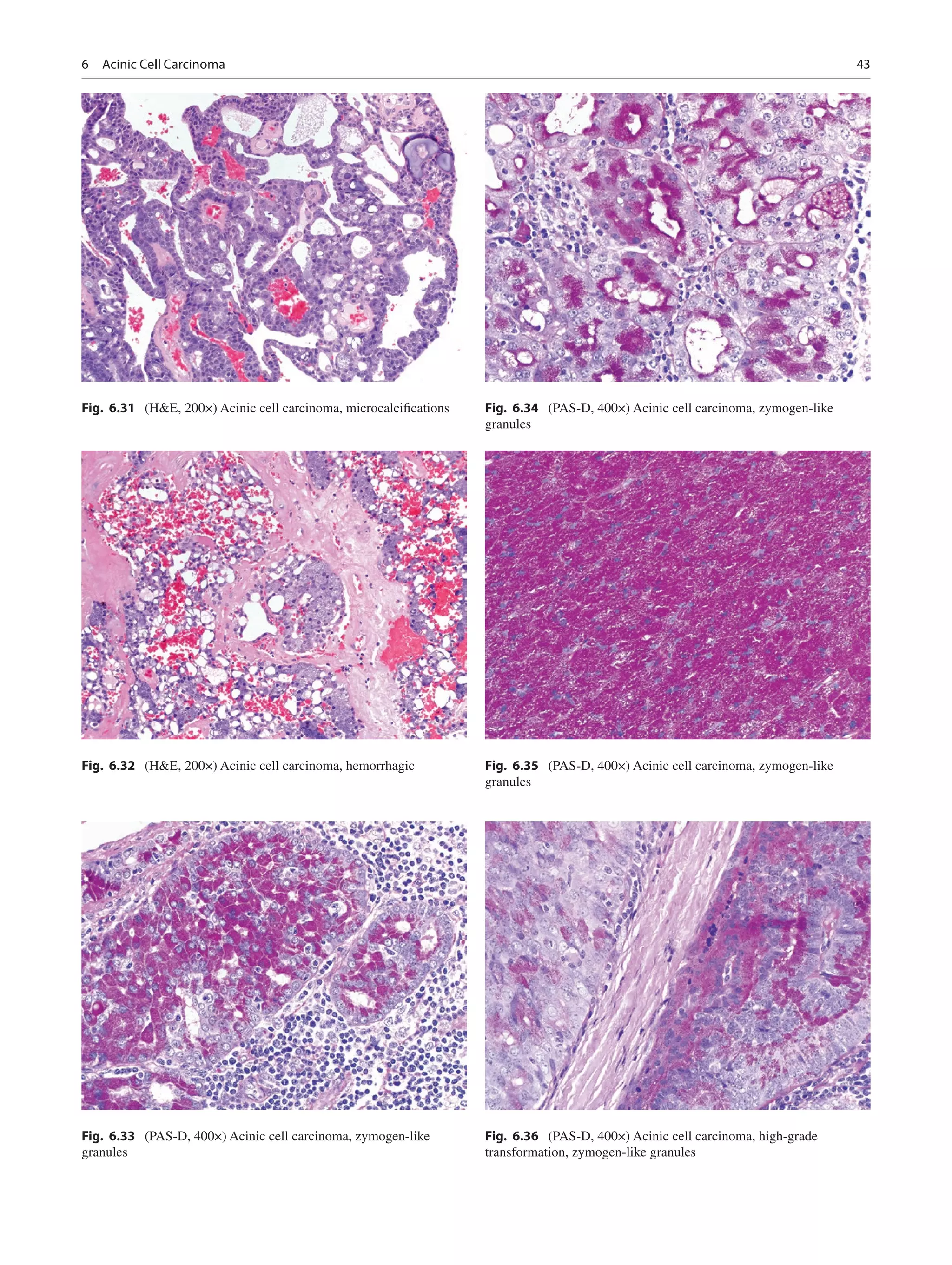 Atlas of salivary gland pathology | PDF