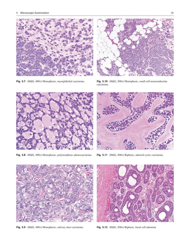 Atlas of salivary gland pathology | PDF