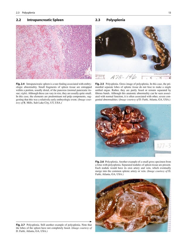 Atlas of spleen pathology | PDF | Digestive Disorders | Diseases and ...