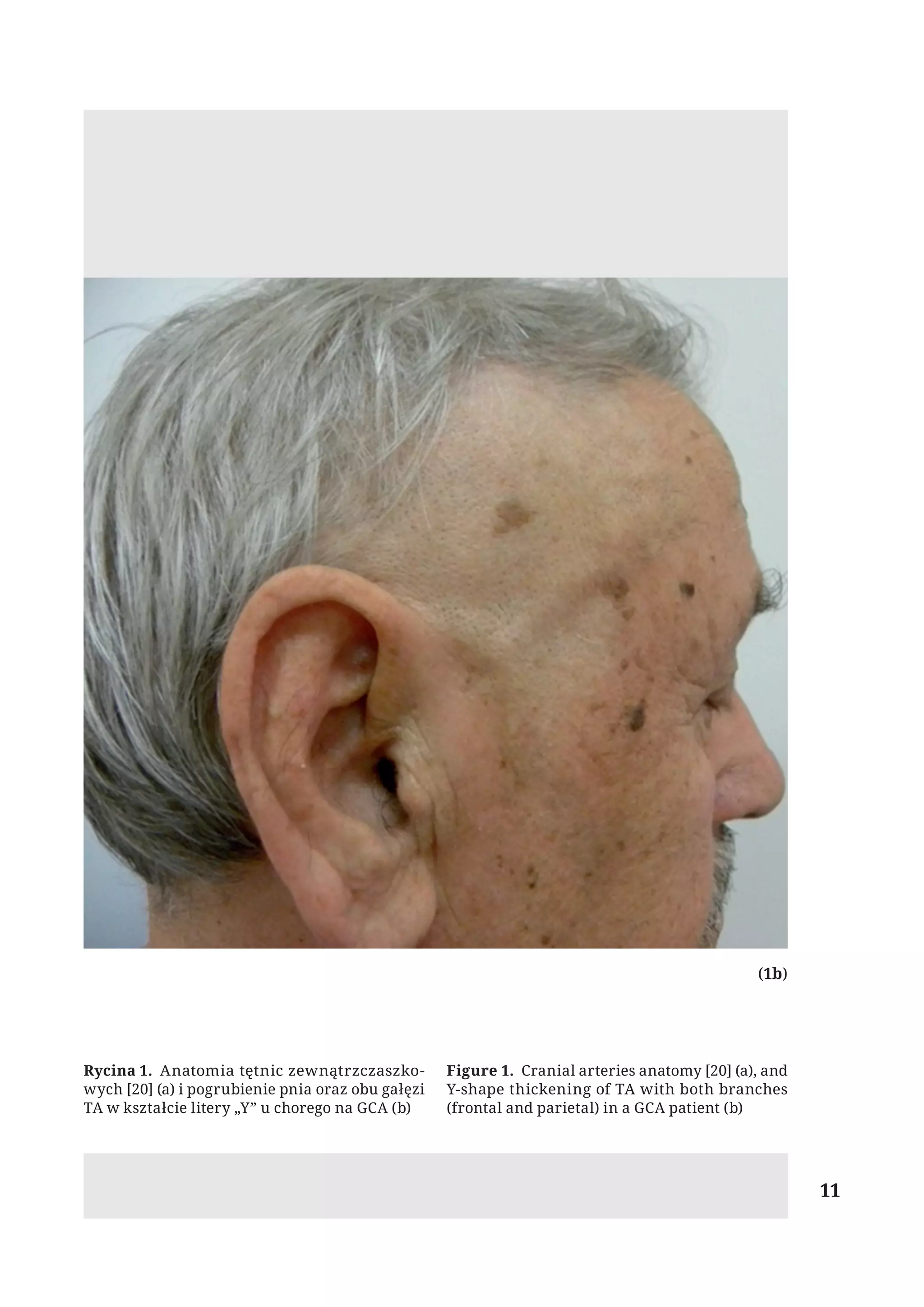 Atlas of ultrasound application in large vessel vasculitis giant cell ...