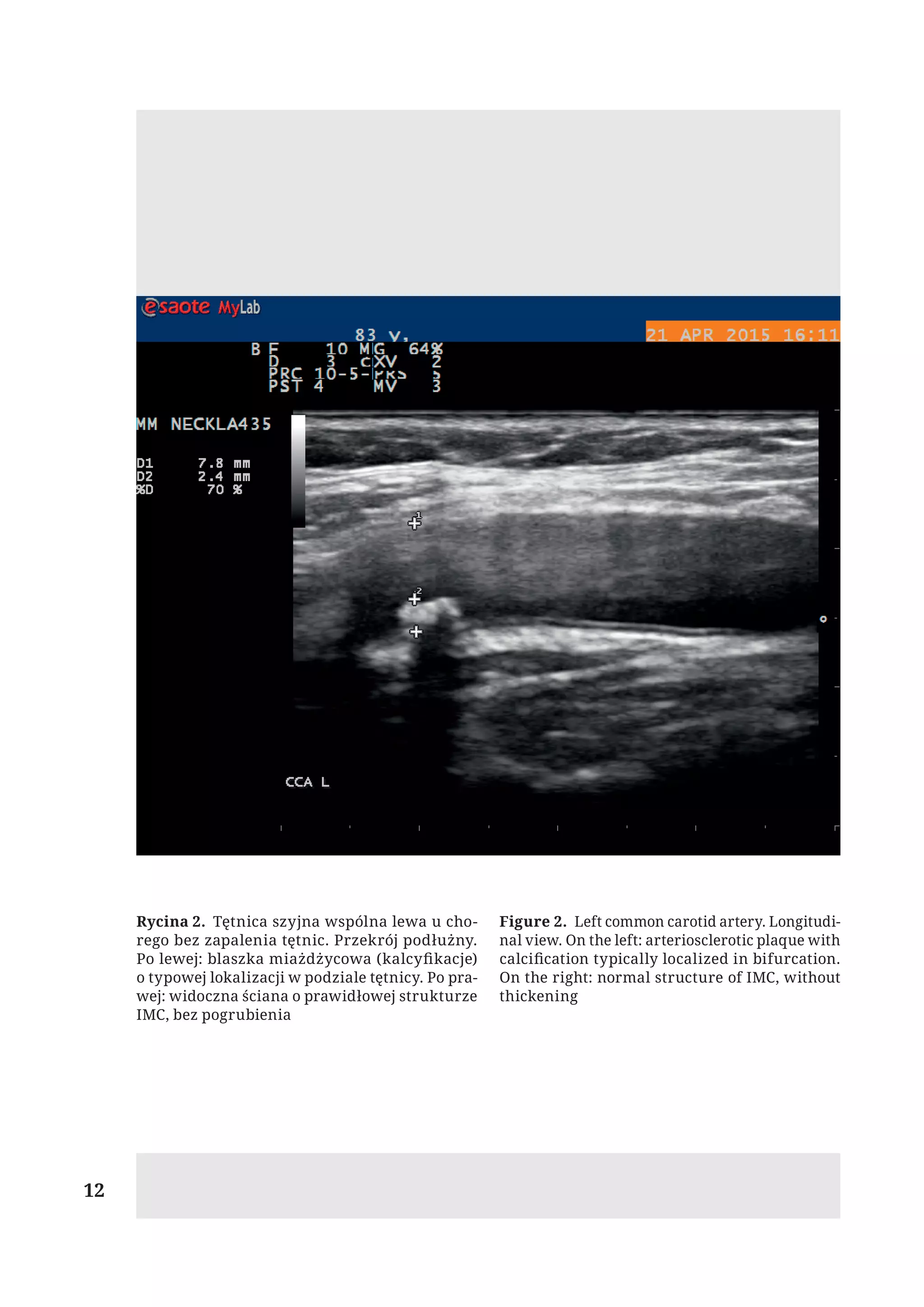 Atlas of ultrasound application in large vessel vasculitis giant cell arteritis and takayasu ...