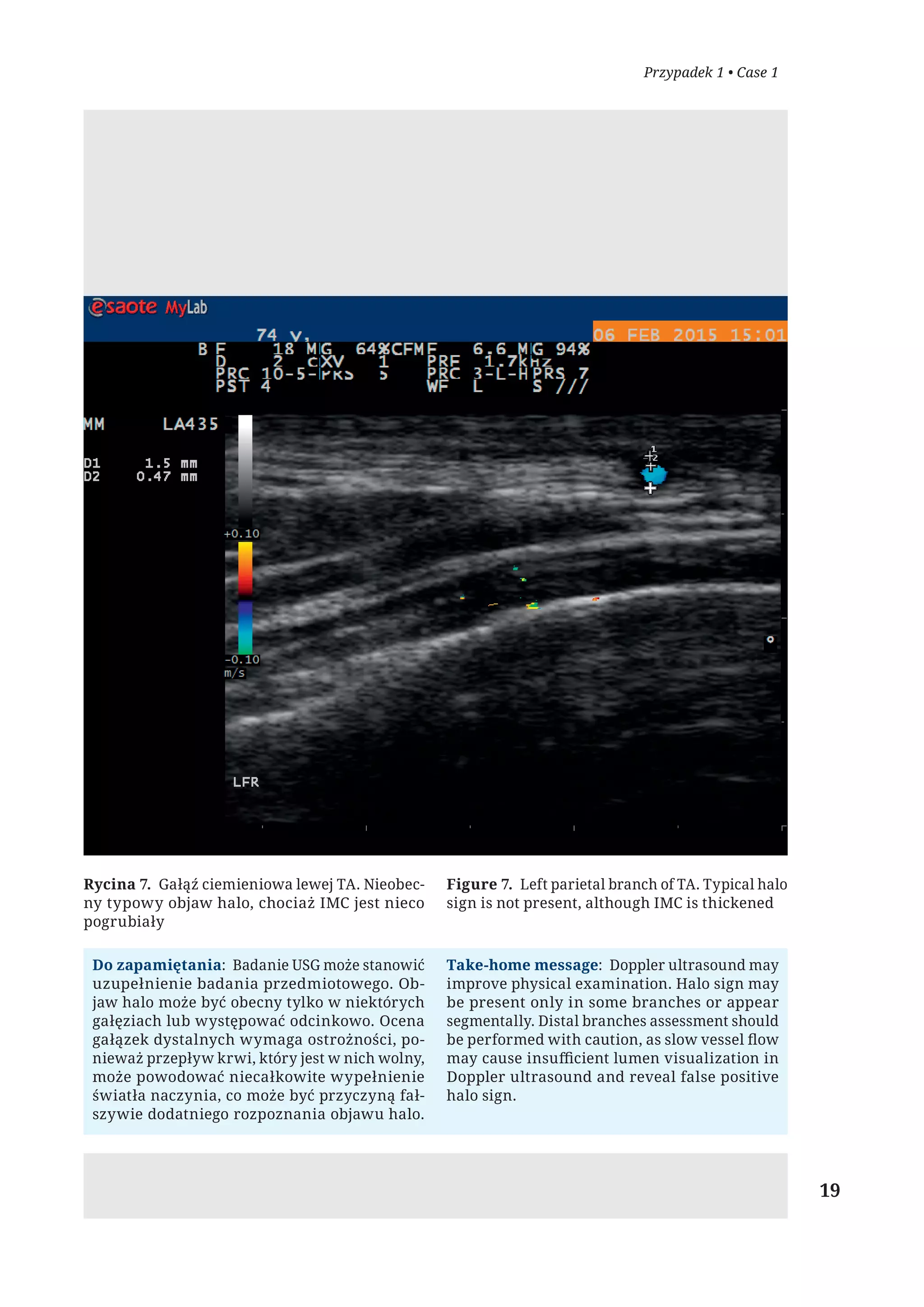 Atlas of ultrasound application in large vessel vasculitis giant cell arteritis and takayasu ...
