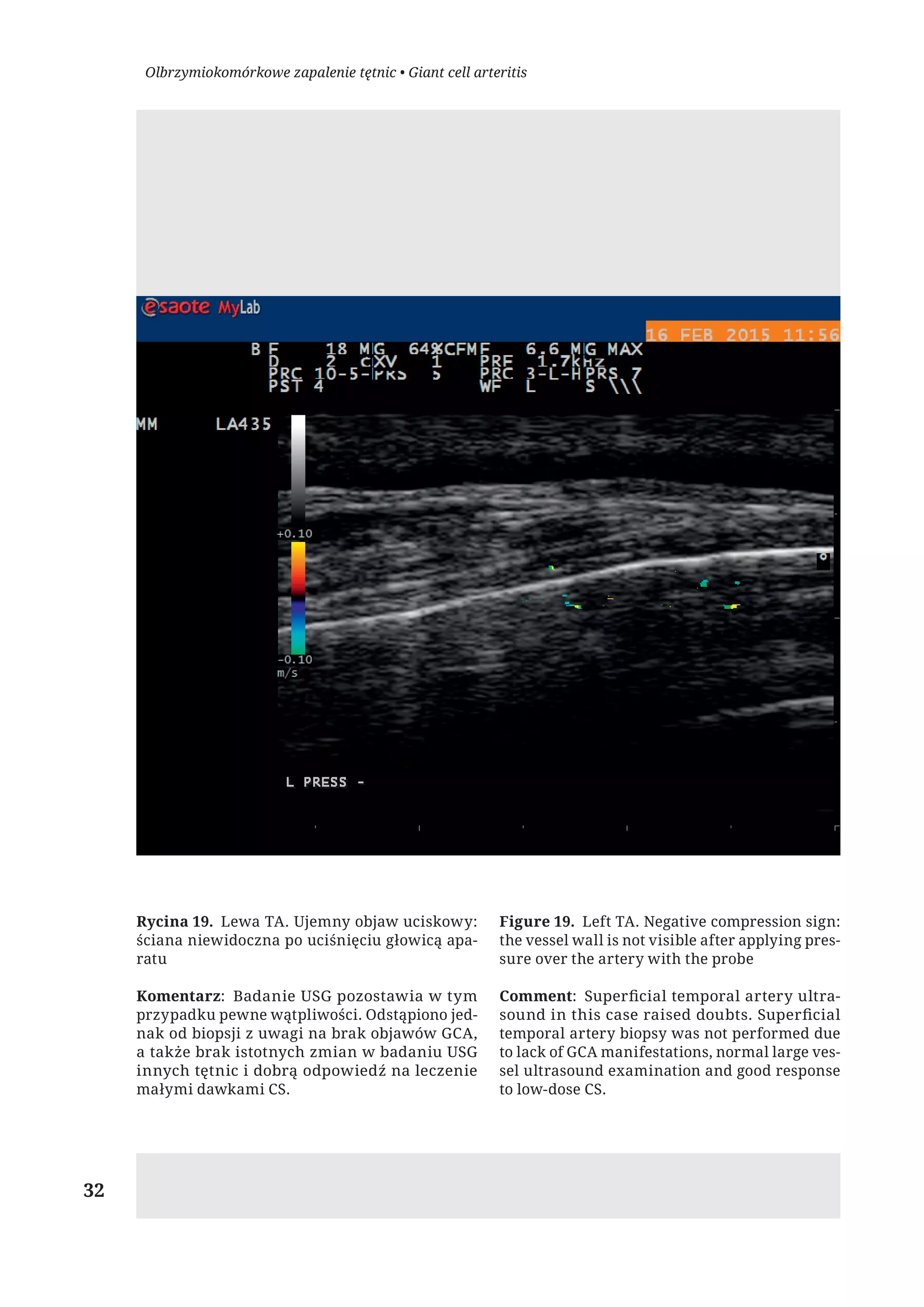 Atlas of ultrasound application in large vessel vasculitis giant cell arteritis and takayasu ...