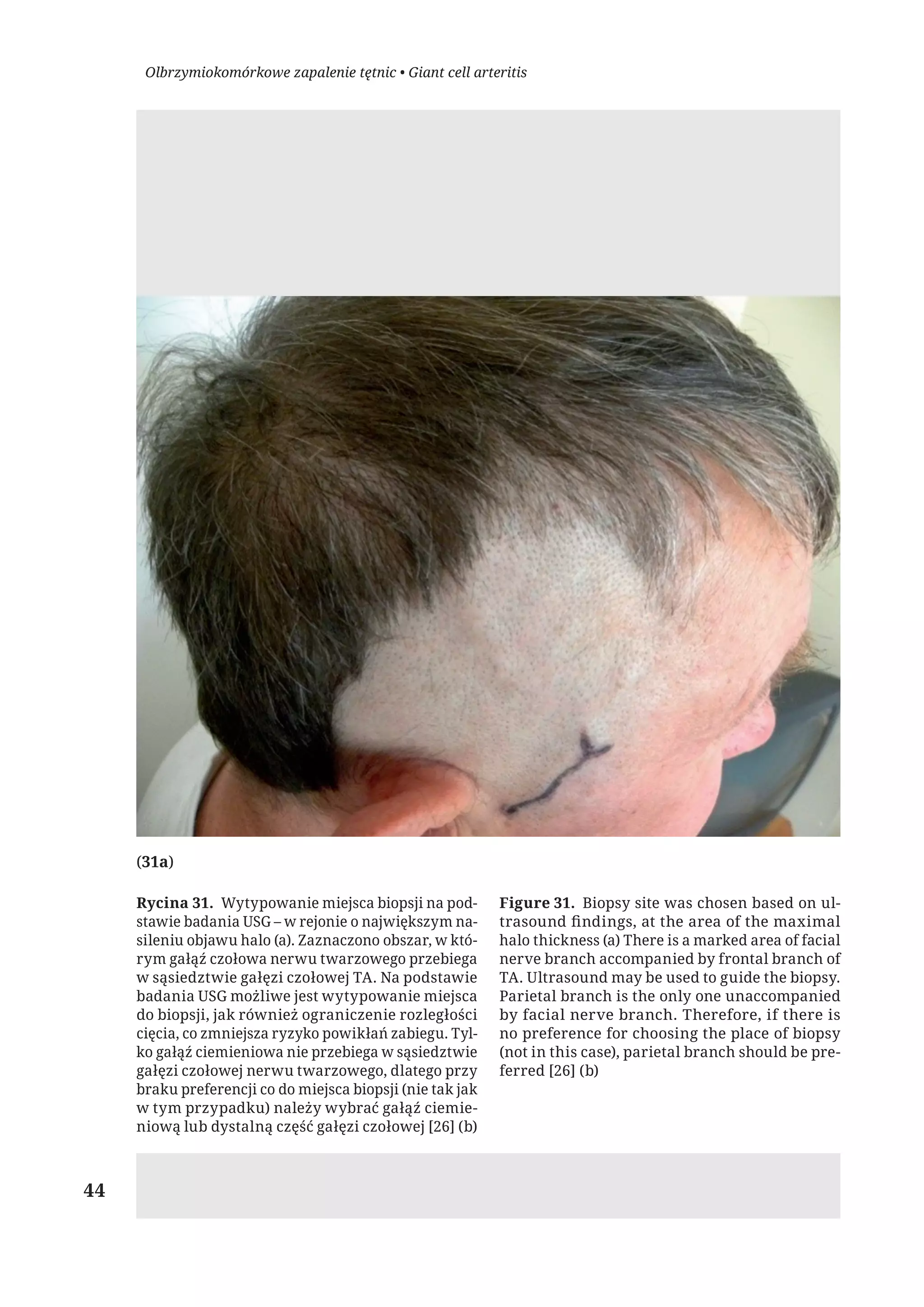 Atlas of ultrasound application in large vessel vasculitis giant cell ...