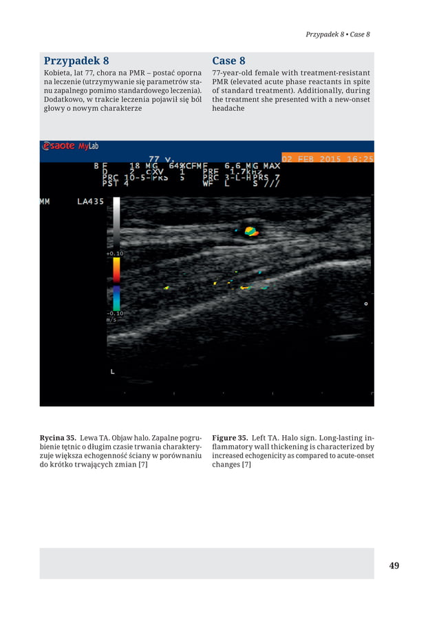 Atlas of ultrasound application in large vessel vasculitis giant cell arteritis and takayasu ...
