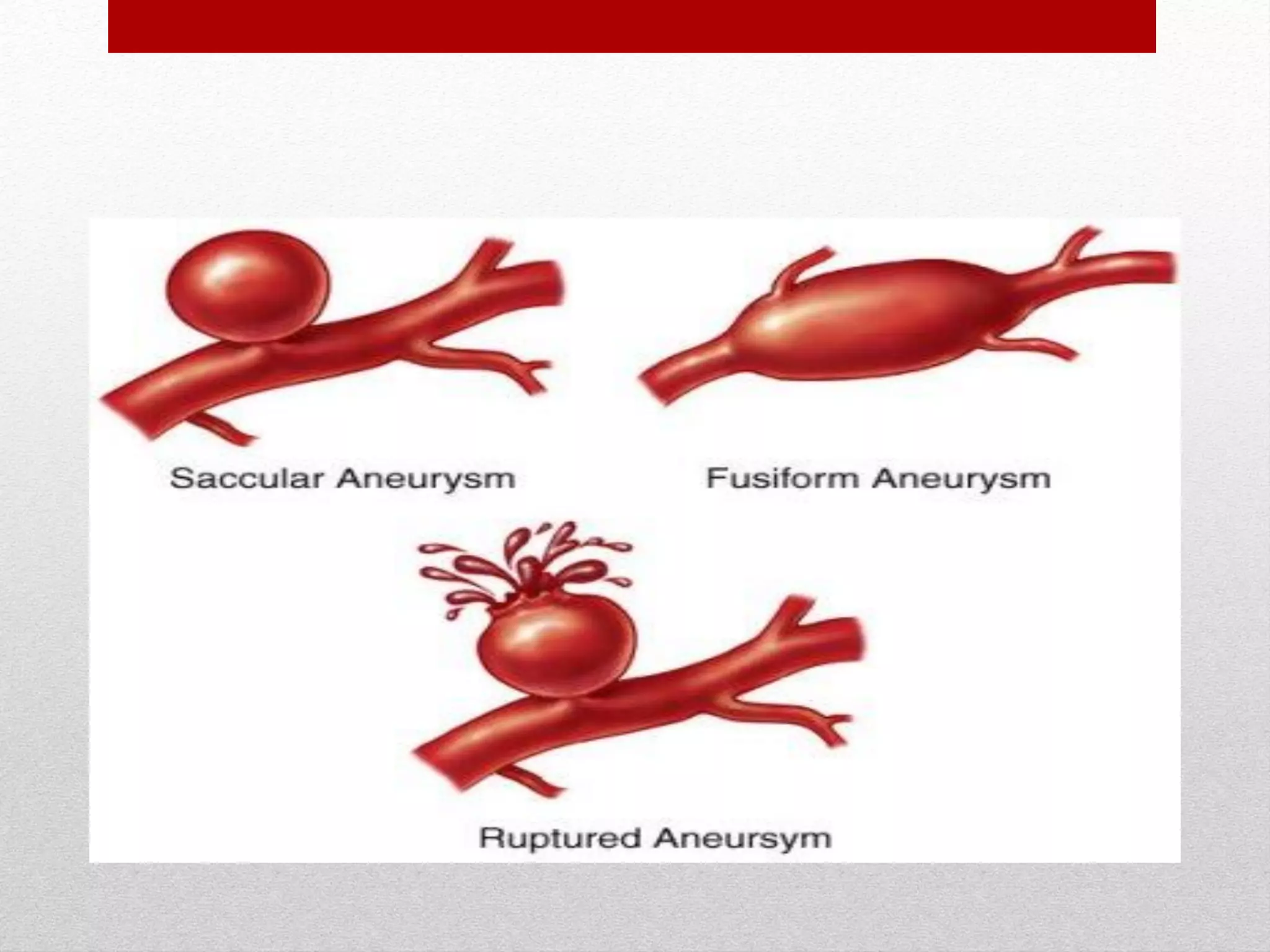 Subarachnoid Hemorrhage Ppt Free Download