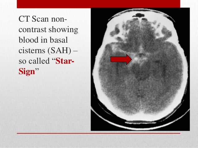 SUBARACHNOID HEMORRHAGE