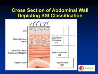 Atlas surgical site infection | PDF