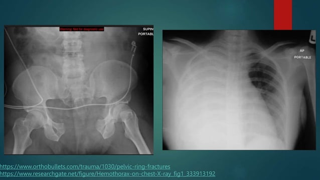 ATLS Protocol.pptx | First Aid | Injuries