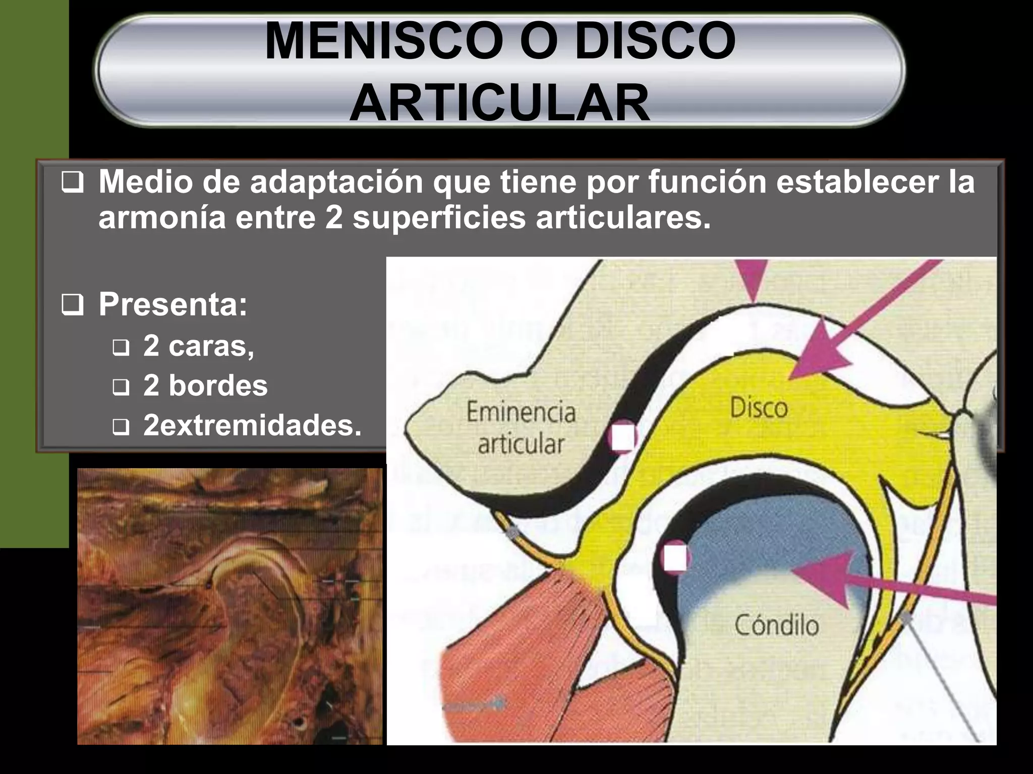 ARTICULACION TEMPORO MANDIBULAR