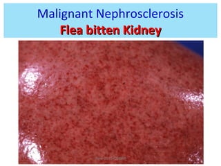 Flea Bitten Kidney