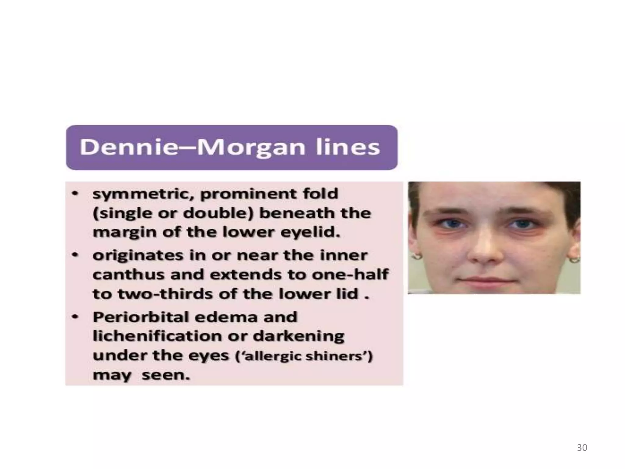 Atophic dermatitis Dr RAVINDRA G O | PPTX