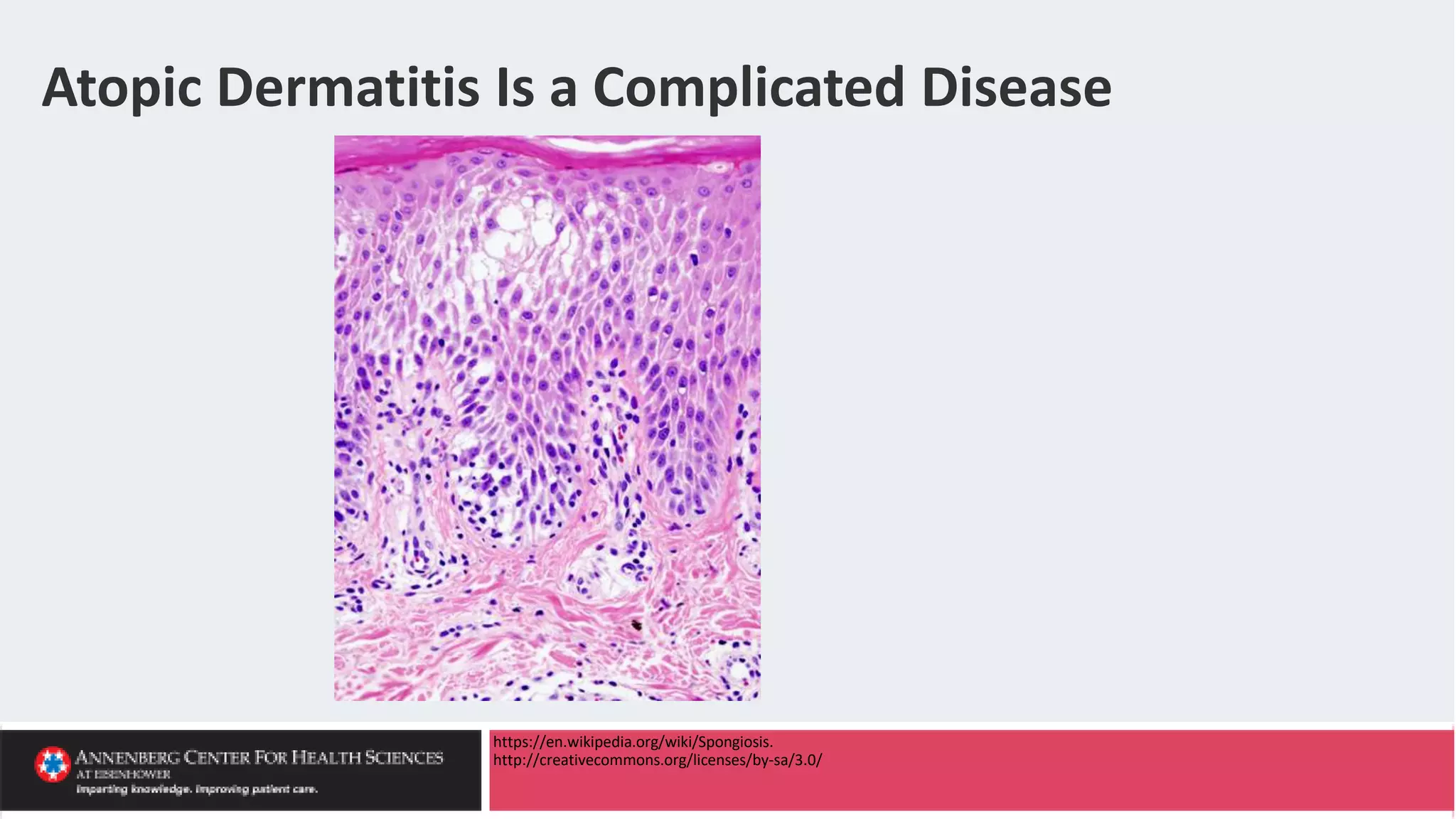 Atopic-Derm-CME_Slides.pptx