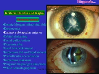 Atopic dermatitis | PPT
