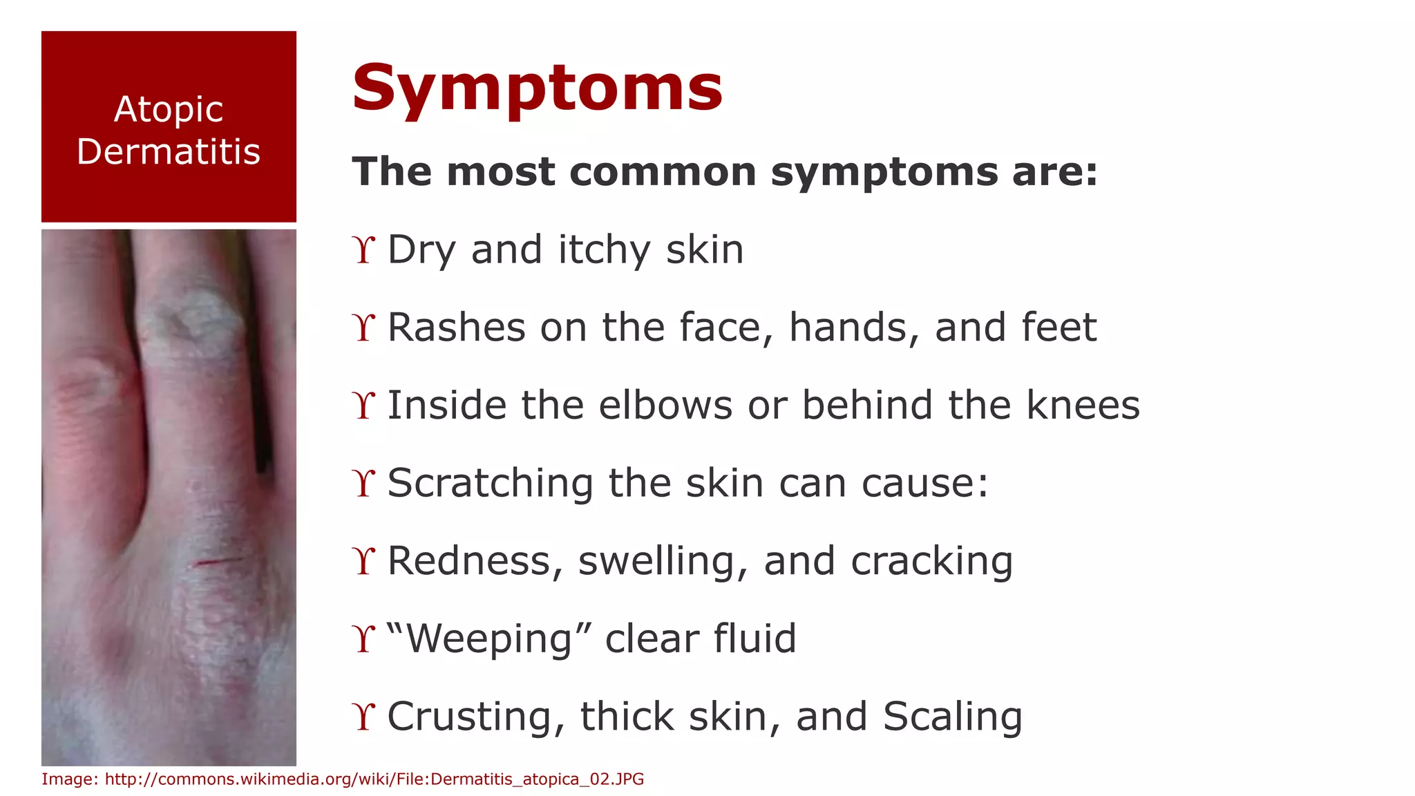 Atopic Dermatitis | PPTX
