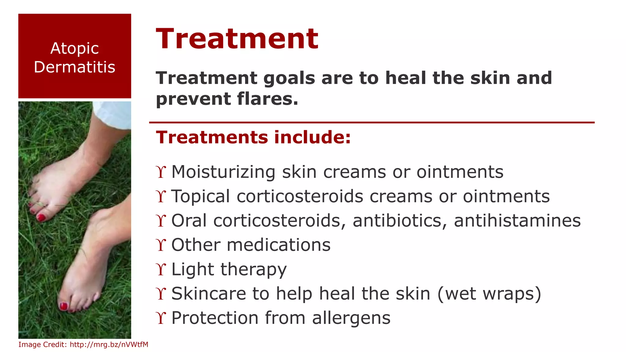 Atopic Dermatitis | PPTX