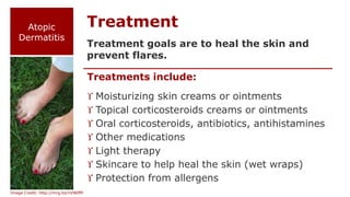 Atopic Dermatitis | PPTX