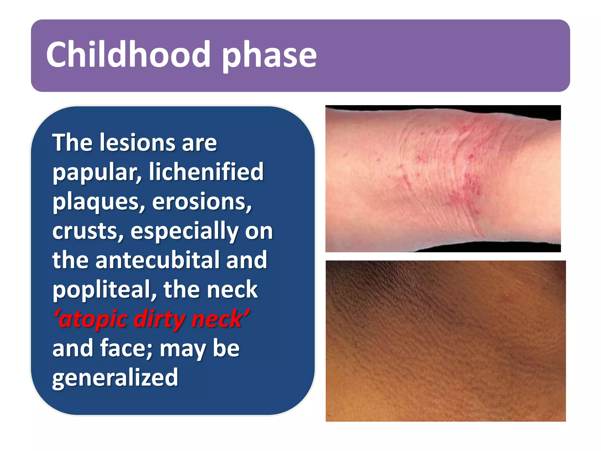 Atopic dermatitis by Dr.Gamal Soltan | PPSX
