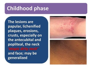 Atopic dermatitis by Dr.Gamal Soltan | PPSX